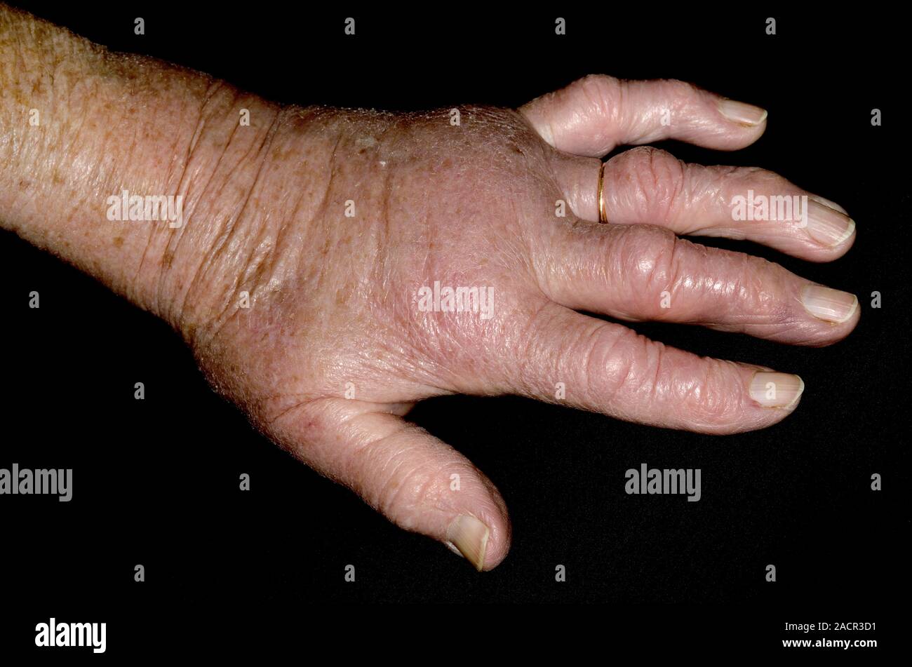 Swelling of the hand of an 89 year old female patient following an ...