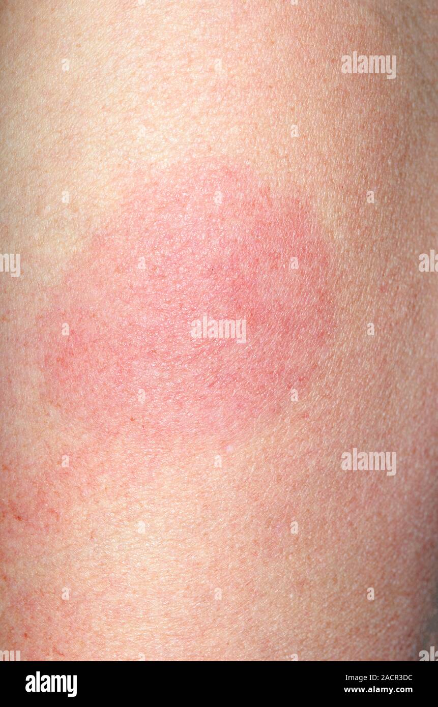 Red swollen area on the skin of the upper arm of a 68 year old female ...