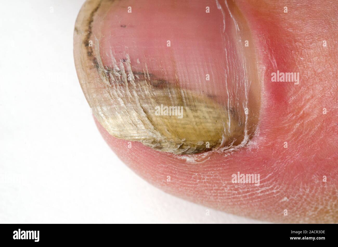 Close-up of a fungal toenail infection (onychomycosis) in a 16 year old ...