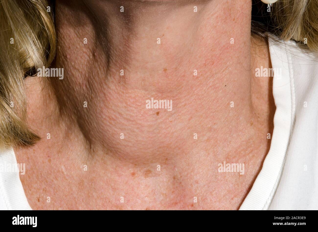 Swelling in the neck of a 50 year old female patient due to a thyroid ...