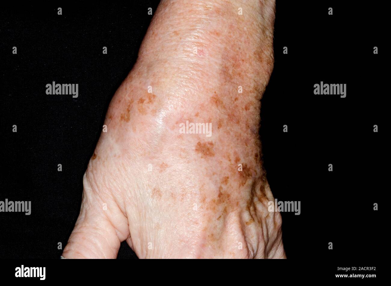 Swelling (tophus) in the wrist of an 82 year old female patient with ...