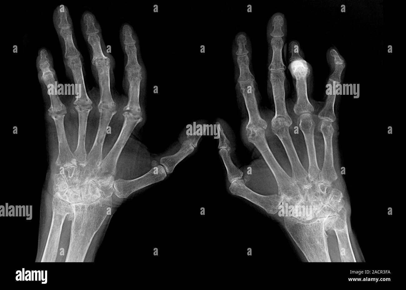 X-ray of the hands of an 80 year old female patient showing deformed ...