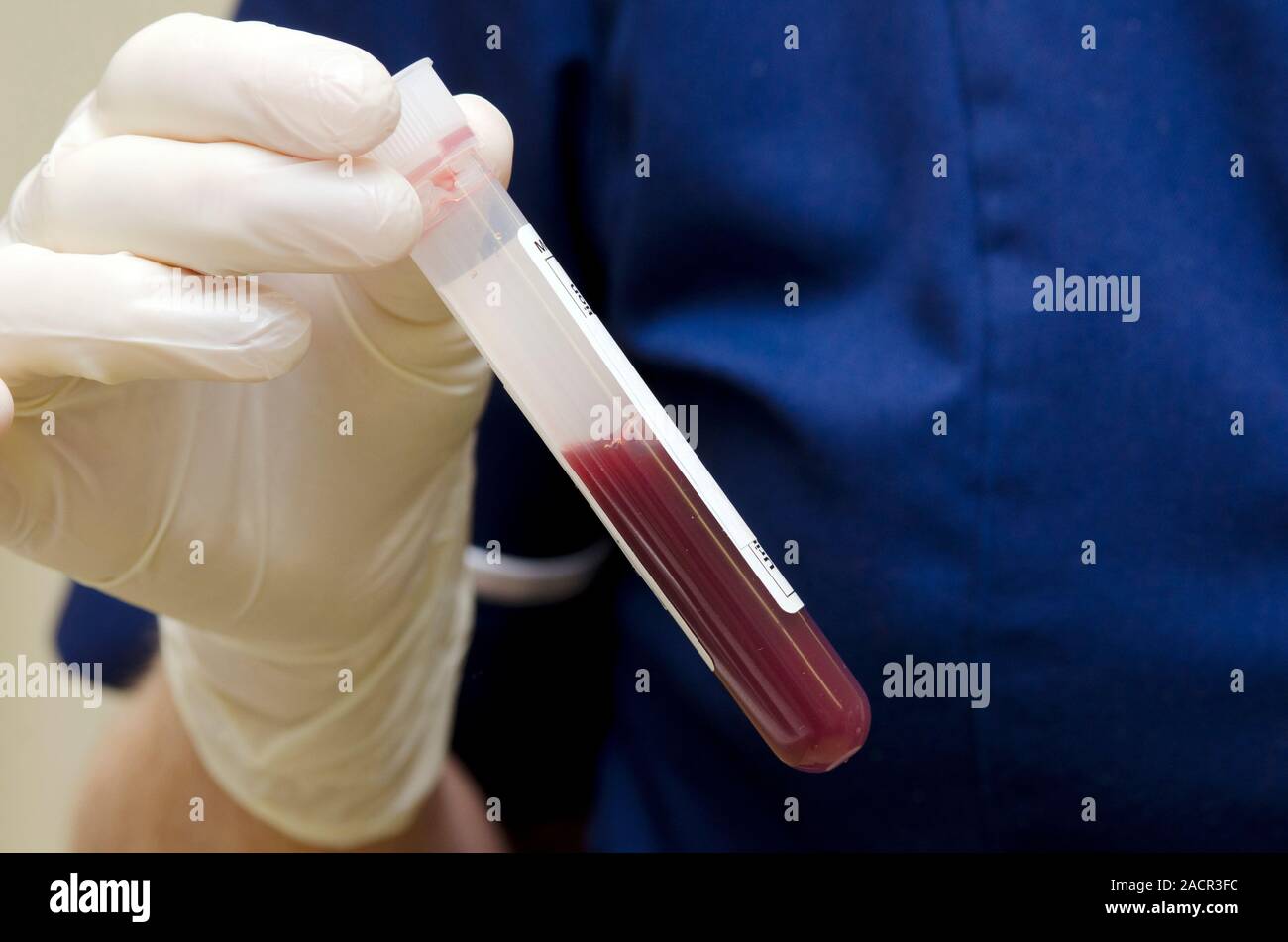 Blood in urine (haematuria) from a 92 year old male patient with ...