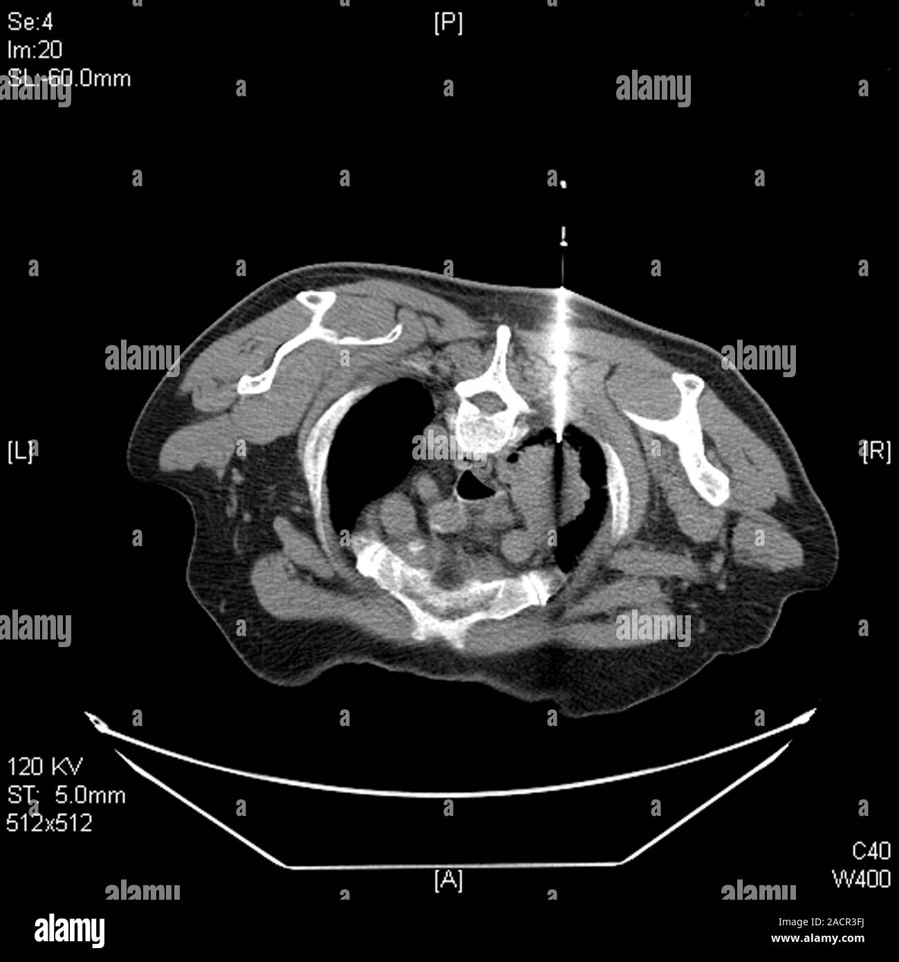 Computed tomography (CT) scan in axial section showing a biopsy needle ...