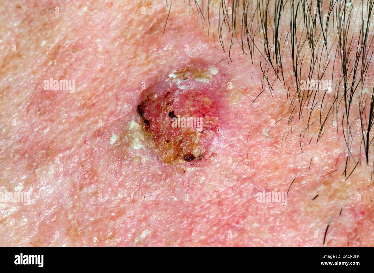 Close-up of squamous cell skin cancer (carcinoma) on the temple of a 79 ...