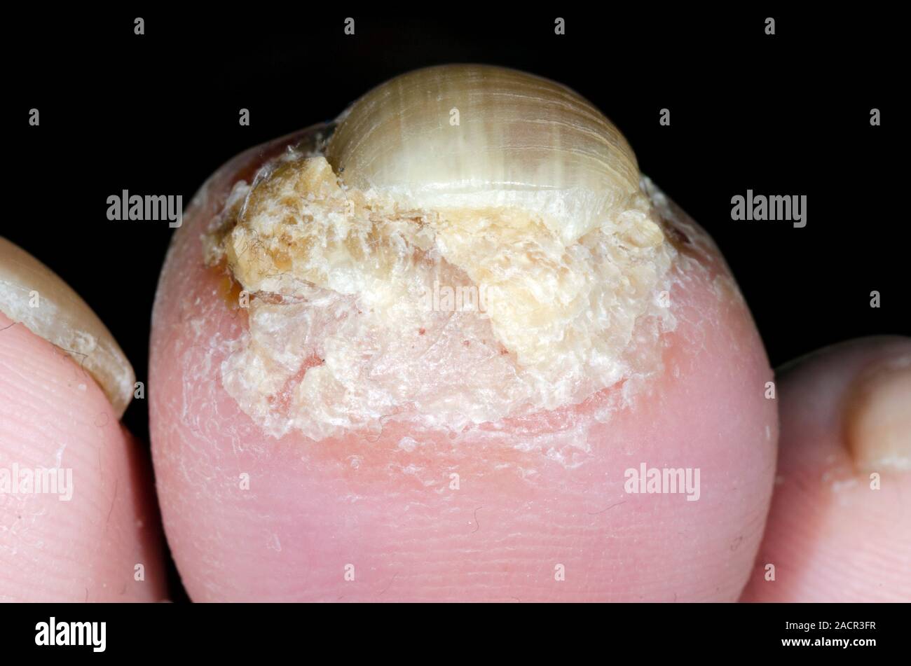 Close-up of the thickened and discoloured toenail of a 58 year old male ...
