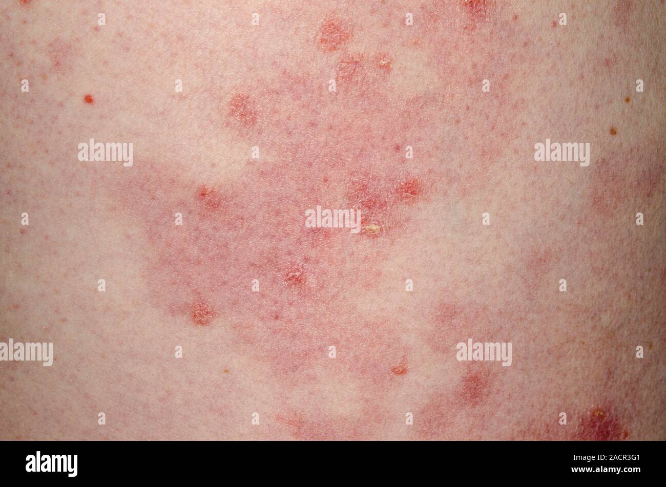 Close-up of resolving (healing) patches of skin on the body of a 36 ...
