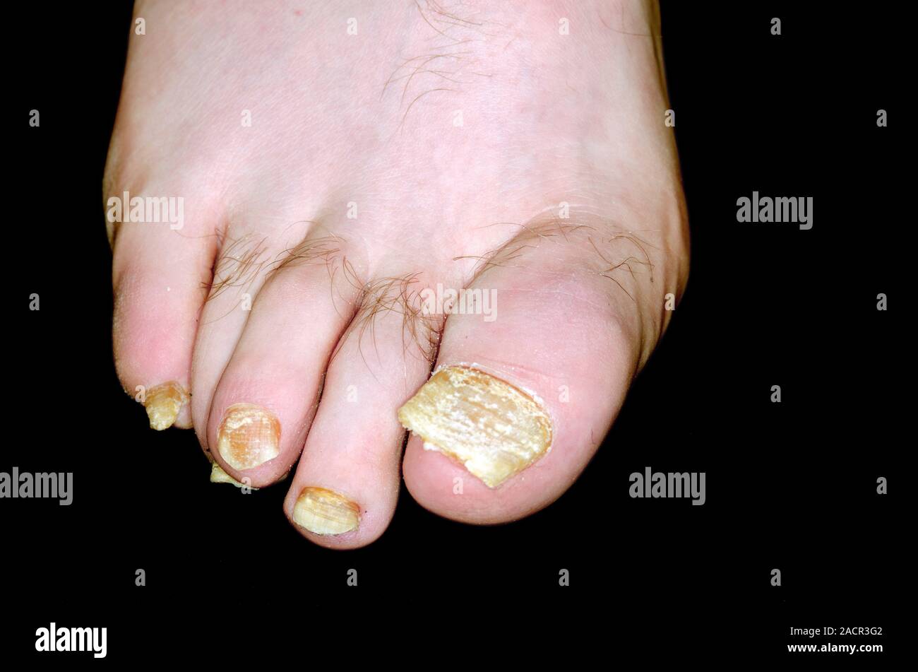 Close-up of the thickened and discoloured toenails of a 36 year old ...