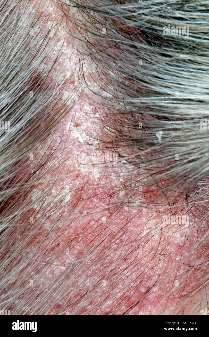 Close-up of red, flaky and thickened skin on the scalp of a 61 year old ...