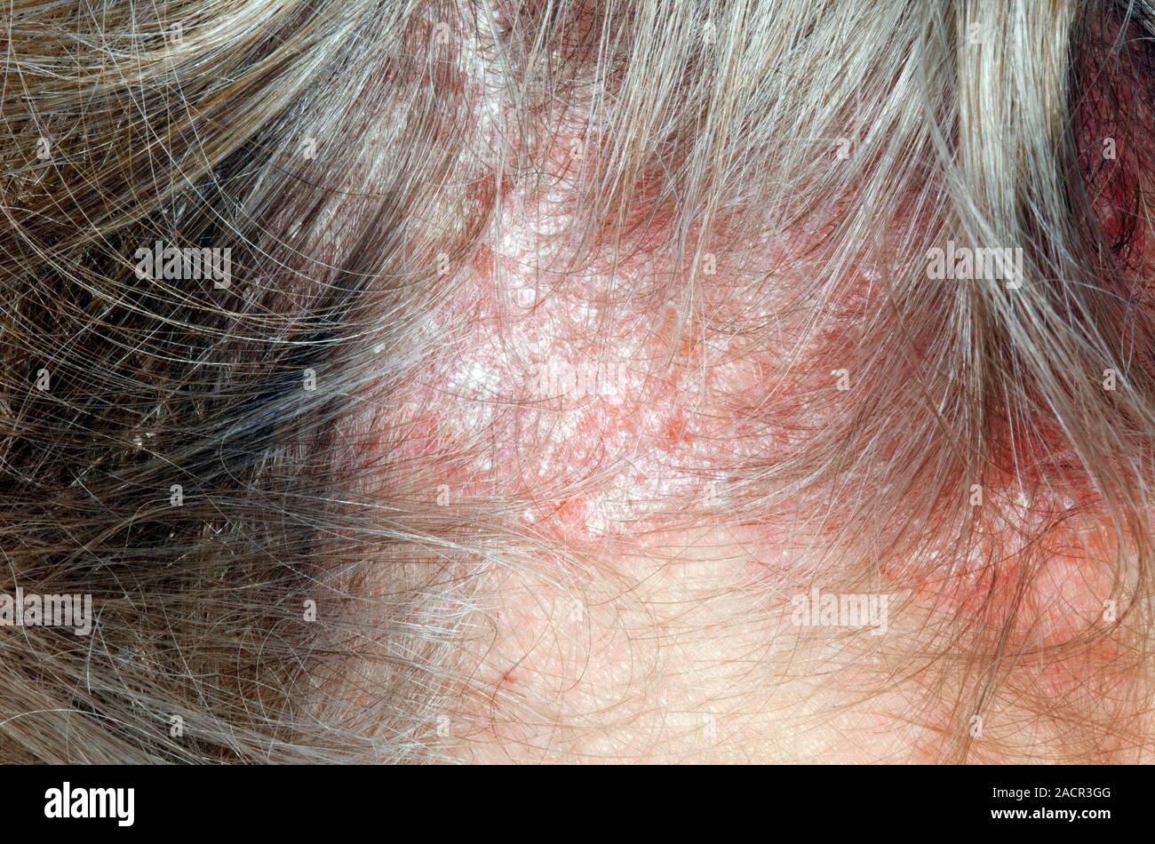 Close-up of red, flaky and thickened skin on the scalp of a 61 year old ...