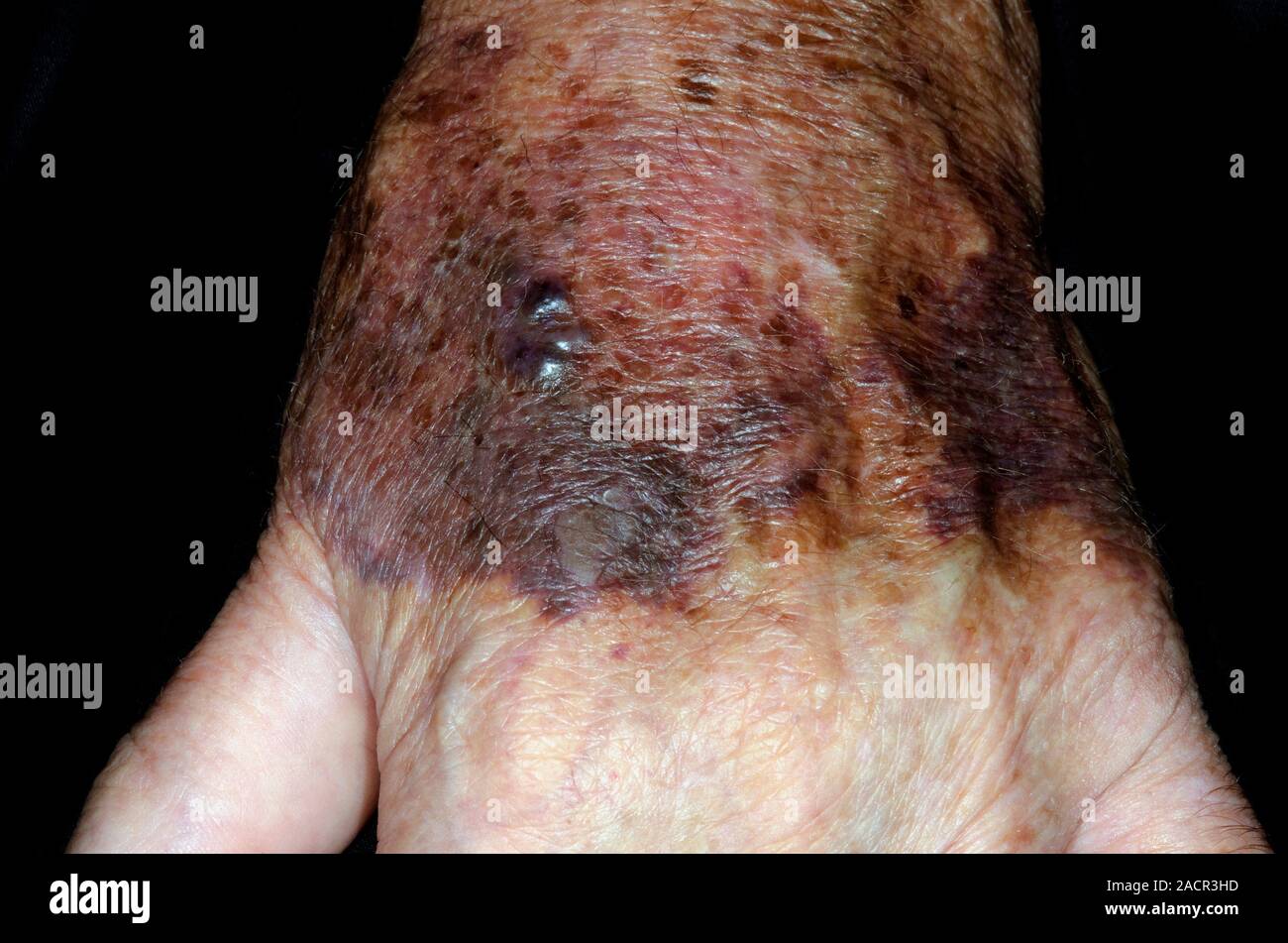 Bruising (haematoma) and blood blister on the hand of a 78 year old ...
