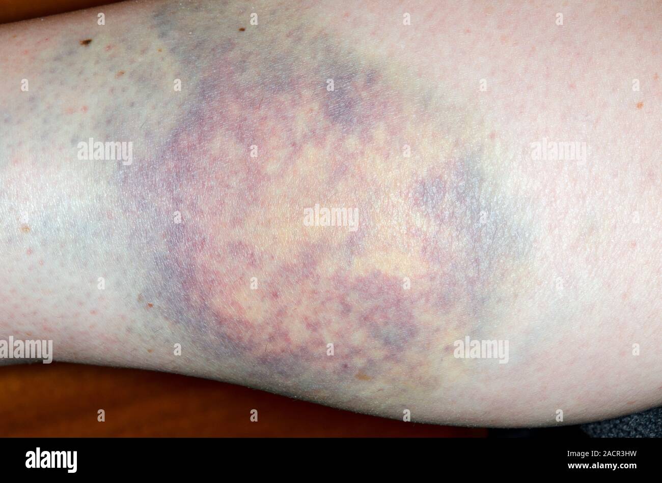 Bruise (haematoma) on the calf of a 61 year old male patient Stock ...