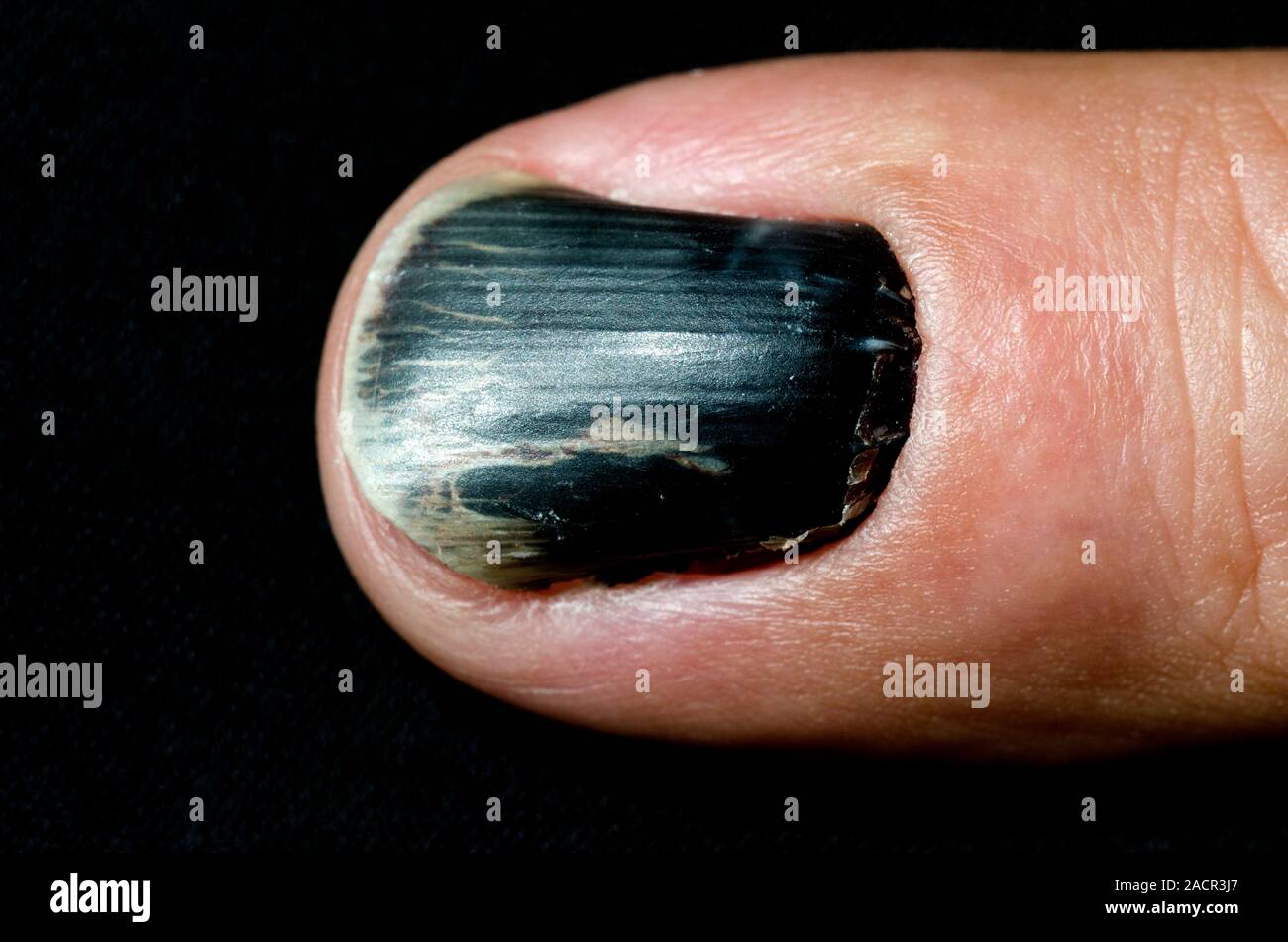 Close-up of bruising (subungual haematoma) under the fingernail of a 78 ...