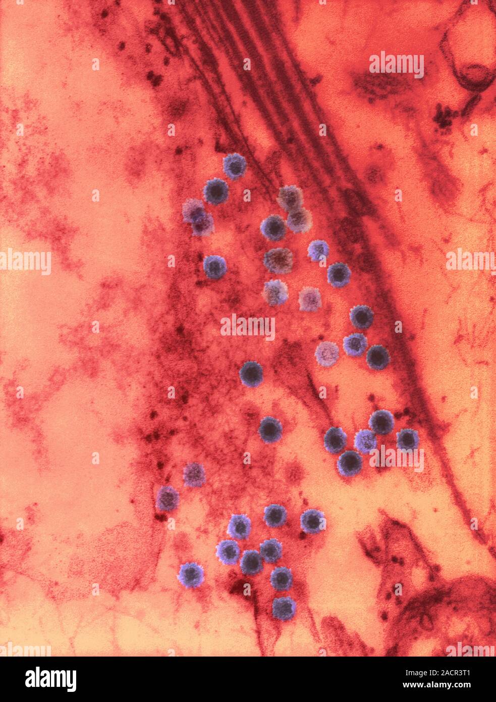 Colorado tick fever virus infection. Transmission electron micrograph ...