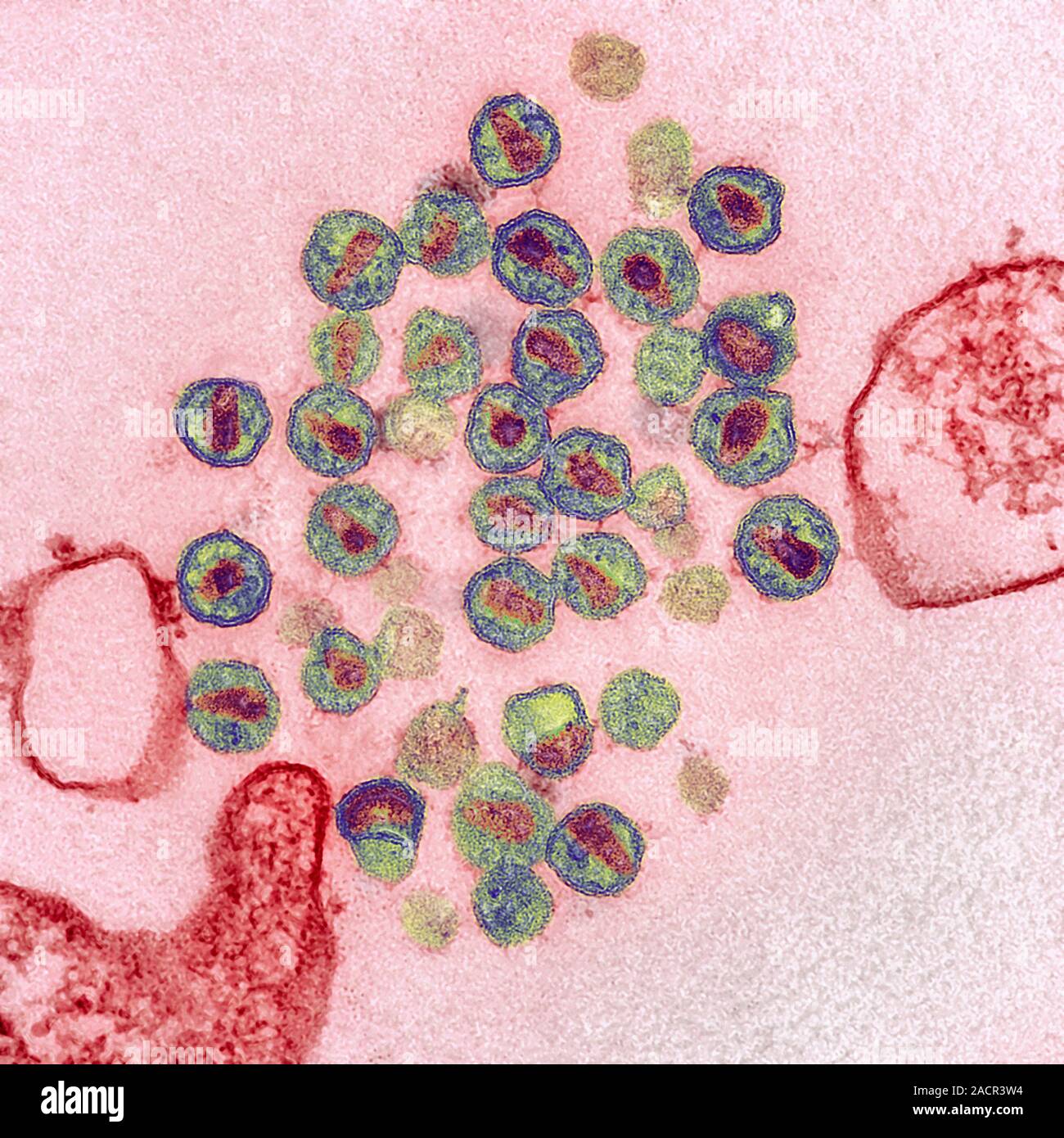 HIV virus particles. Transmission electron micrograph (TEM) of a ...