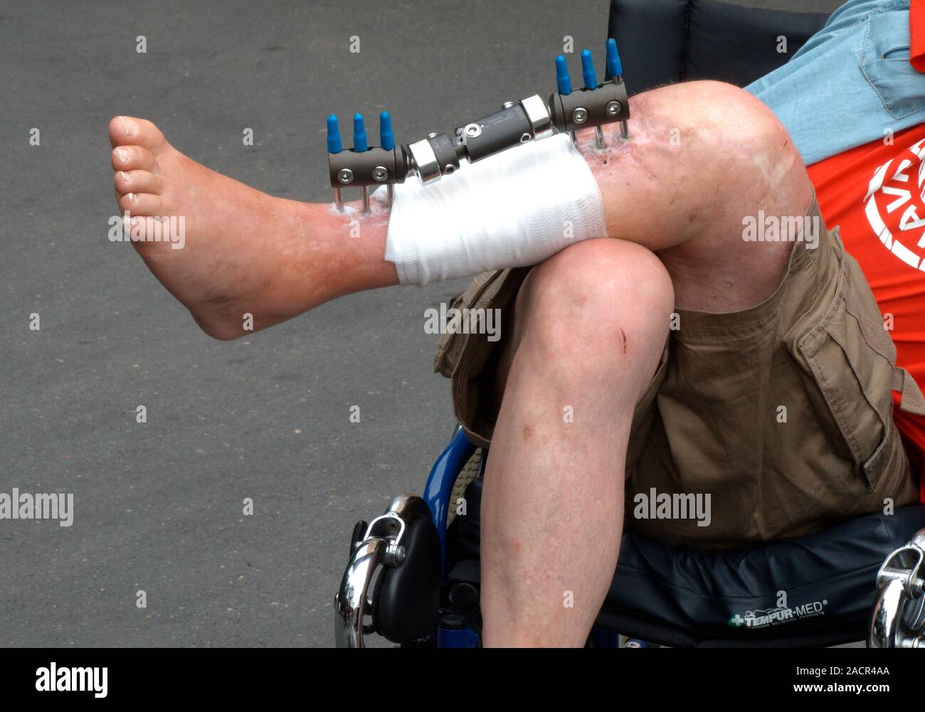 Pinned broken leg. The broken bones in this patient's lower leg have ...