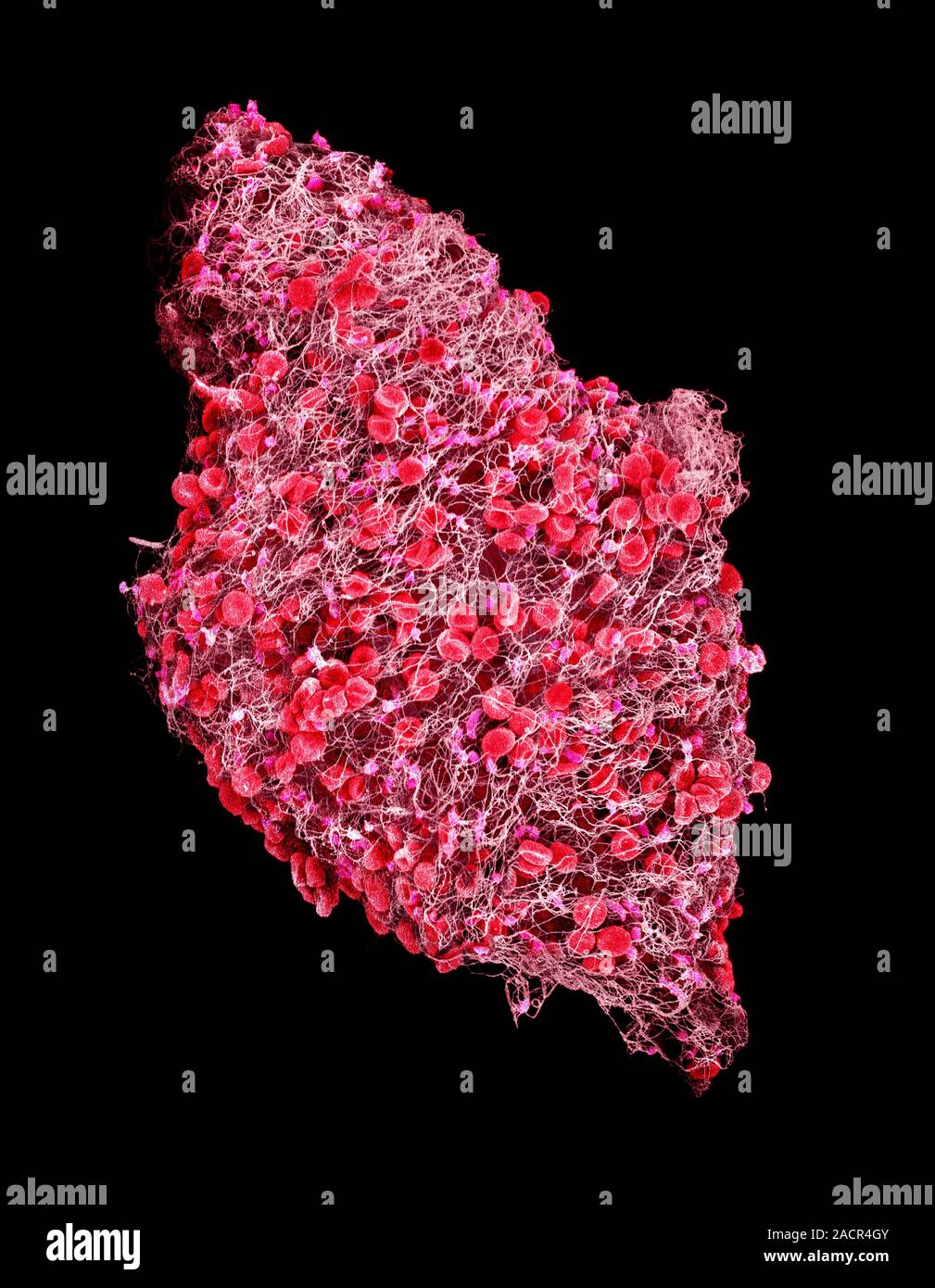 Blood clot, coloured scanning electron micrograph (SEM). Red blood ...