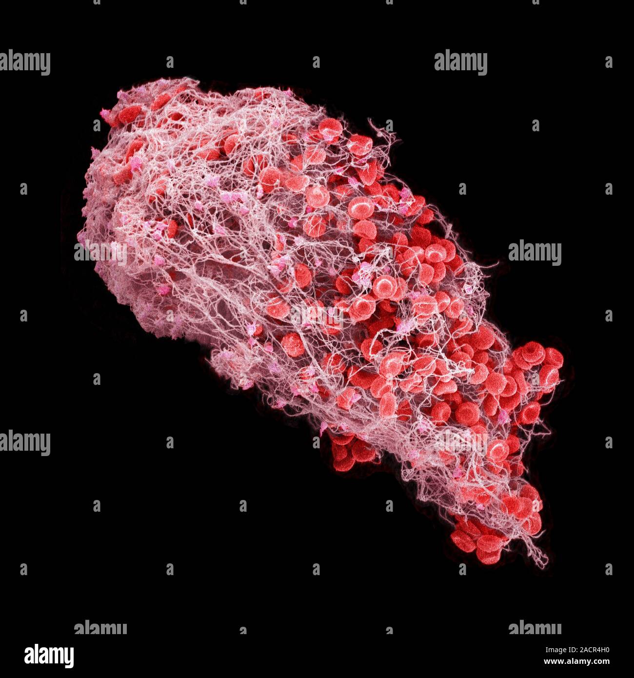 Blood clot, coloured scanning electron micrograph (SEM). Red blood ...