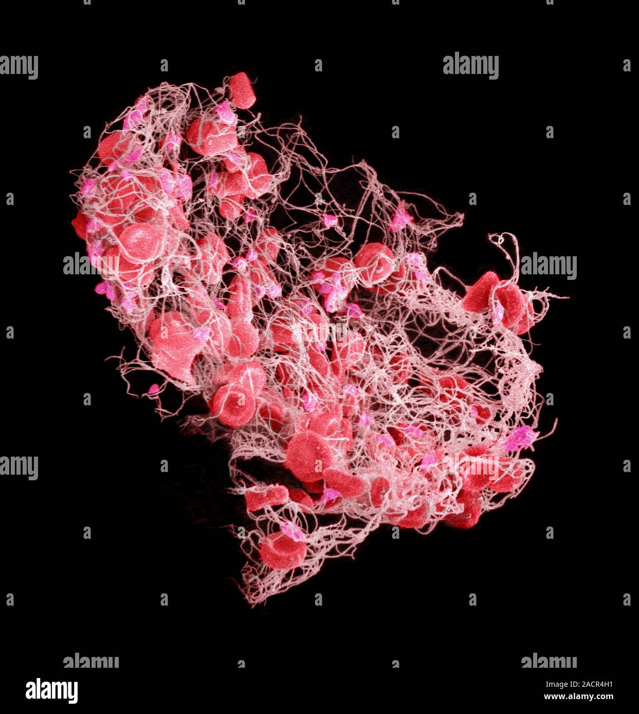 Blood clot, coloured scanning electron micrograph (SEM). Red blood ...