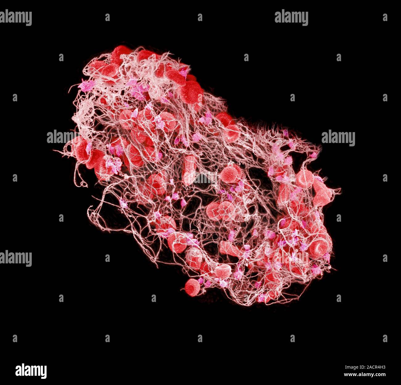 Blood clot, coloured scanning electron micrograph (SEM). Red blood ...