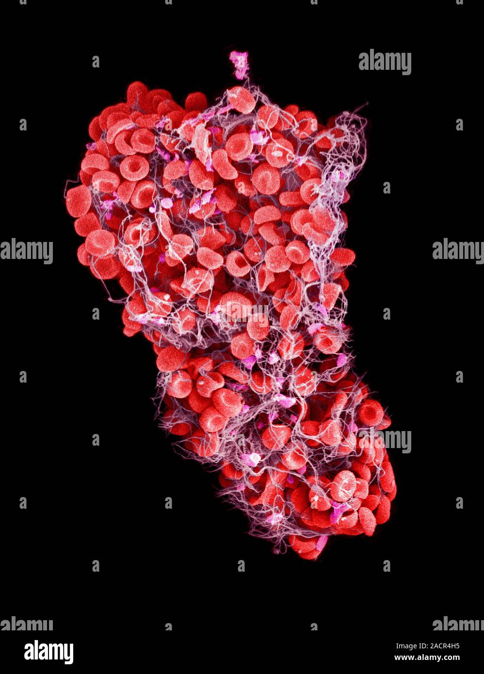 Blood clot, coloured scanning electron micrograph (SEM). Red blood ...