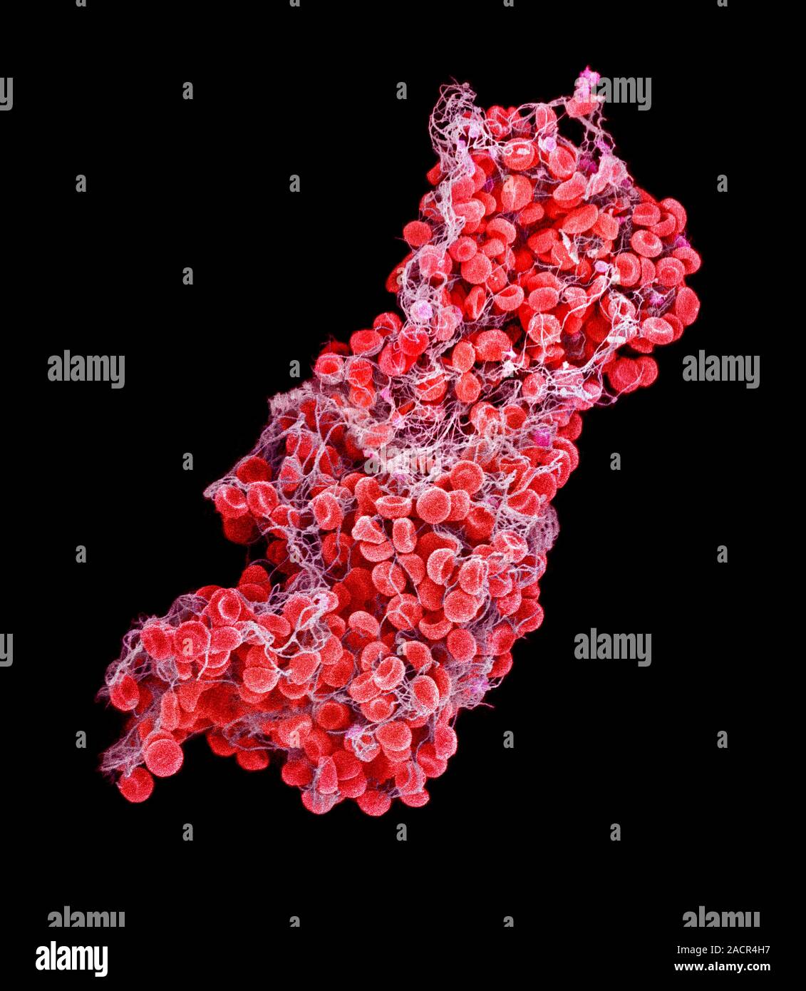 Blood clot, coloured scanning electron micrograph (SEM). Red blood ...