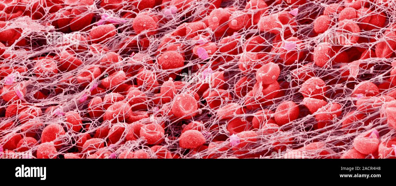 Blood clot, coloured scanning electron micrograph (SEM). Red blood ...