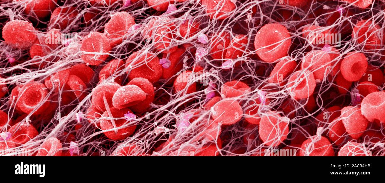 Blood clot, coloured scanning electron micrograph (SEM). Red blood ...