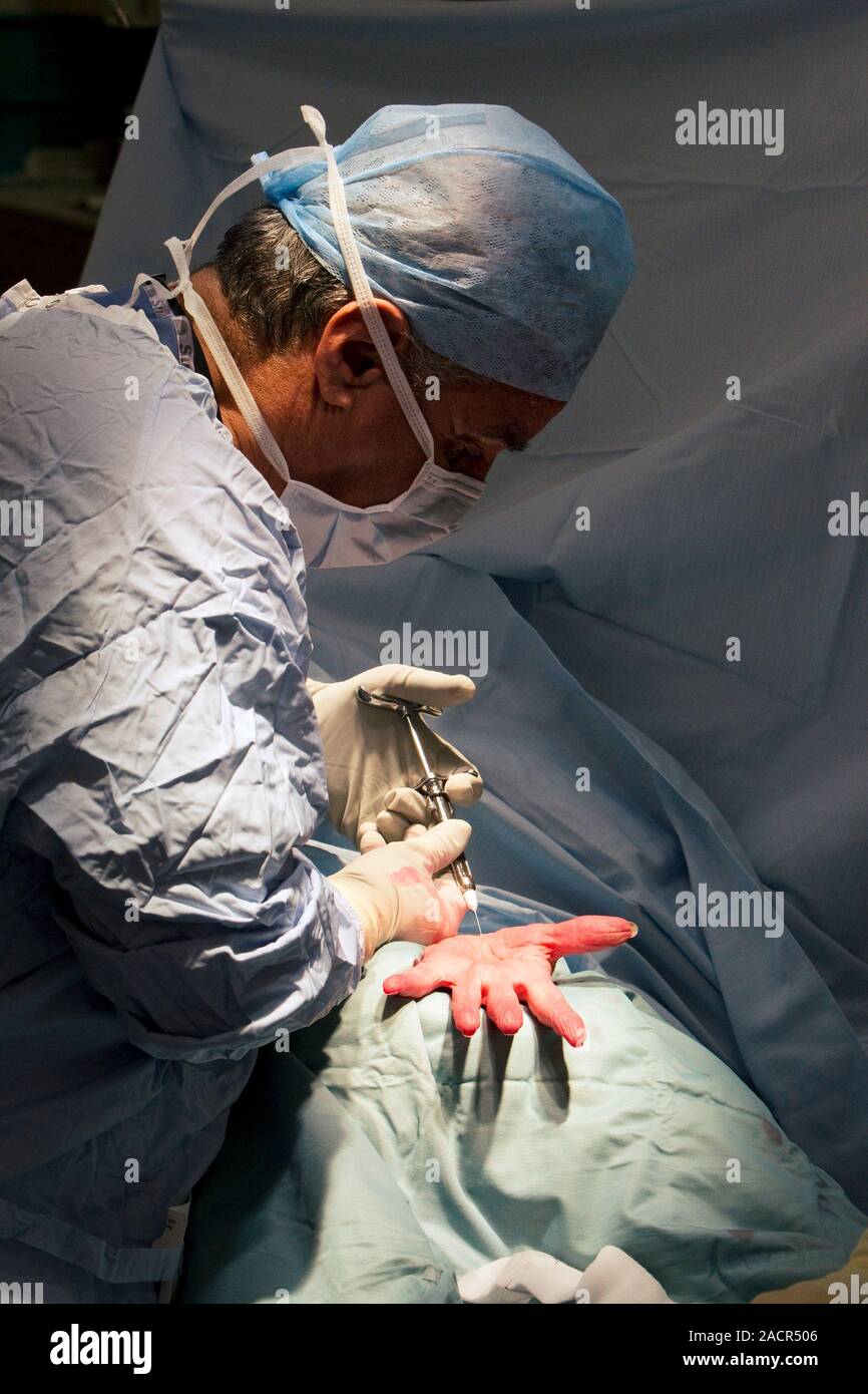 Carpal tunnel syndrome surgery. Surgeon injecting a patient's hand ...