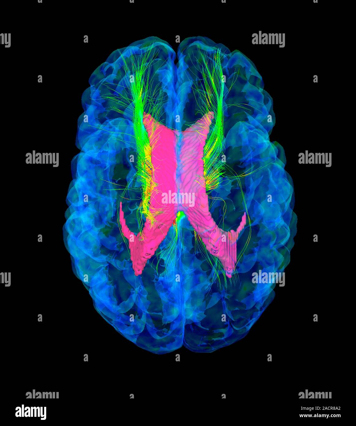 Brain fibres. 3D diffusion tensor imaging (DTI) magnetic resonance imaging (MRI) scan of a ...