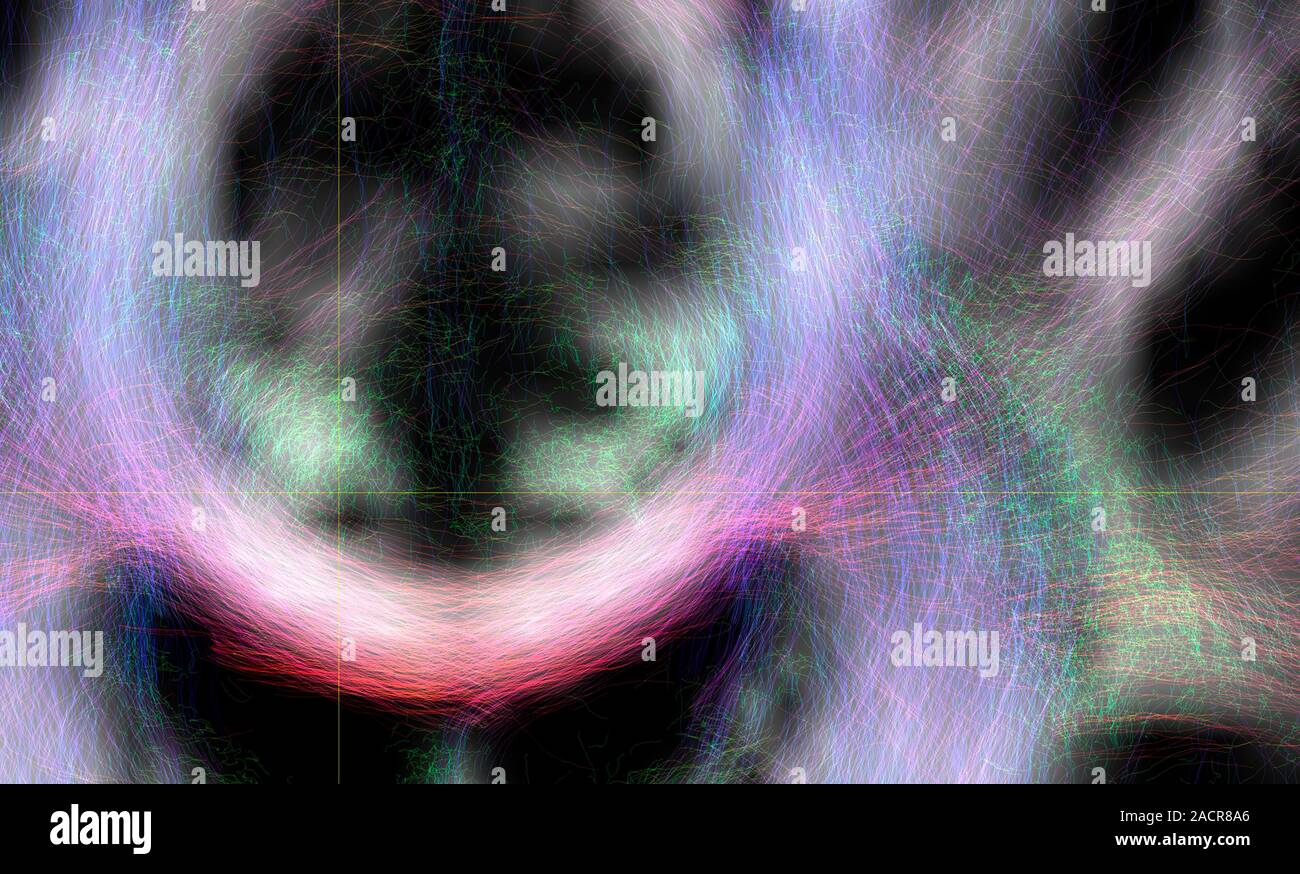 Brain's white matter. Close-up of an area of the brain imaged using ...