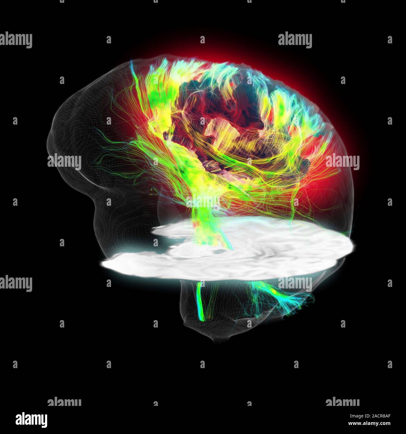 Glioblastoma brain tumour. 3D diffusion tensor imaging (DTI) magnetic resonance imaging (MRI ...