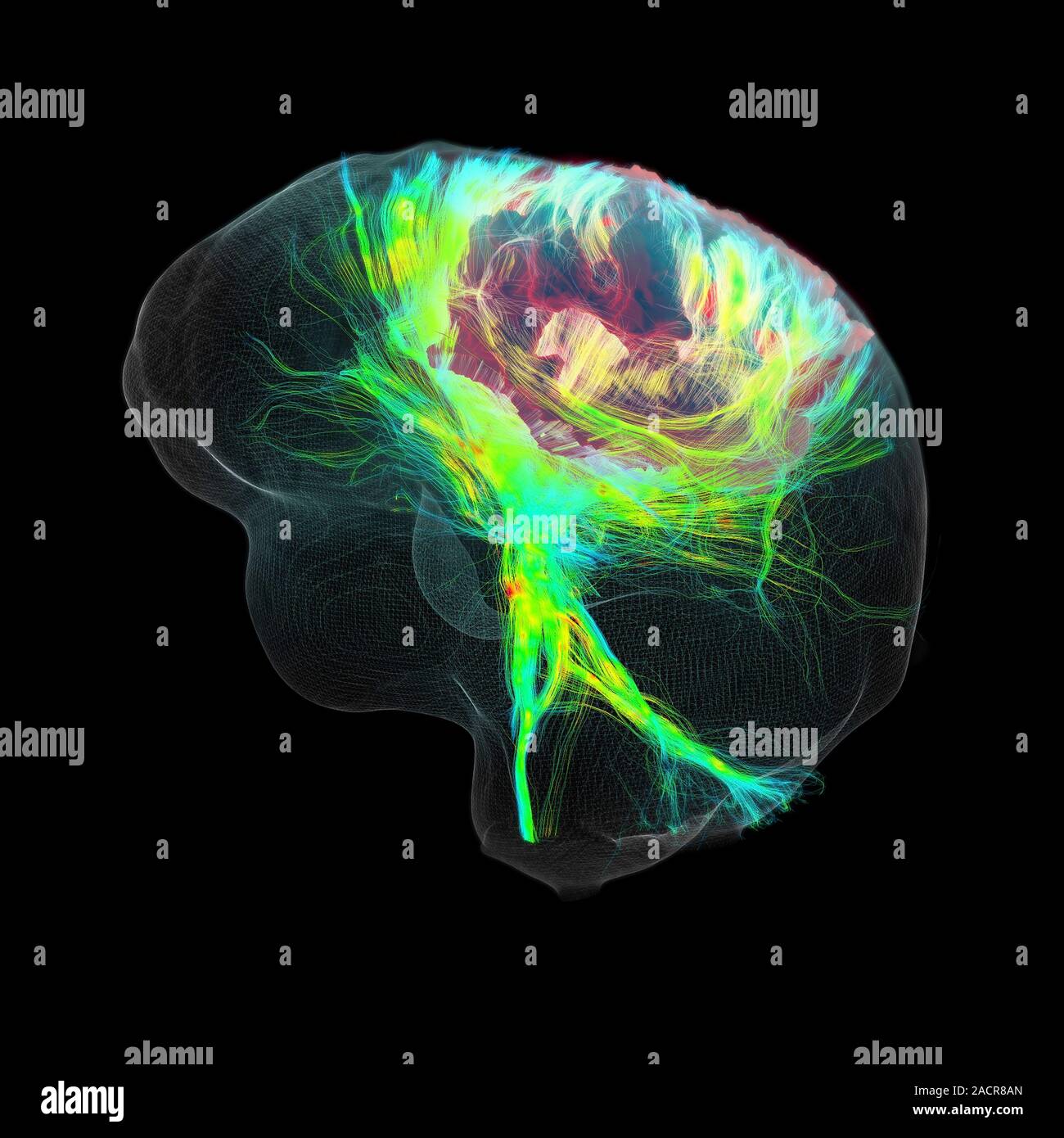 Glioblastoma brain tumour. 3D diffusion tensor imaging (DTI) magnetic resonance imaging (MRI ...