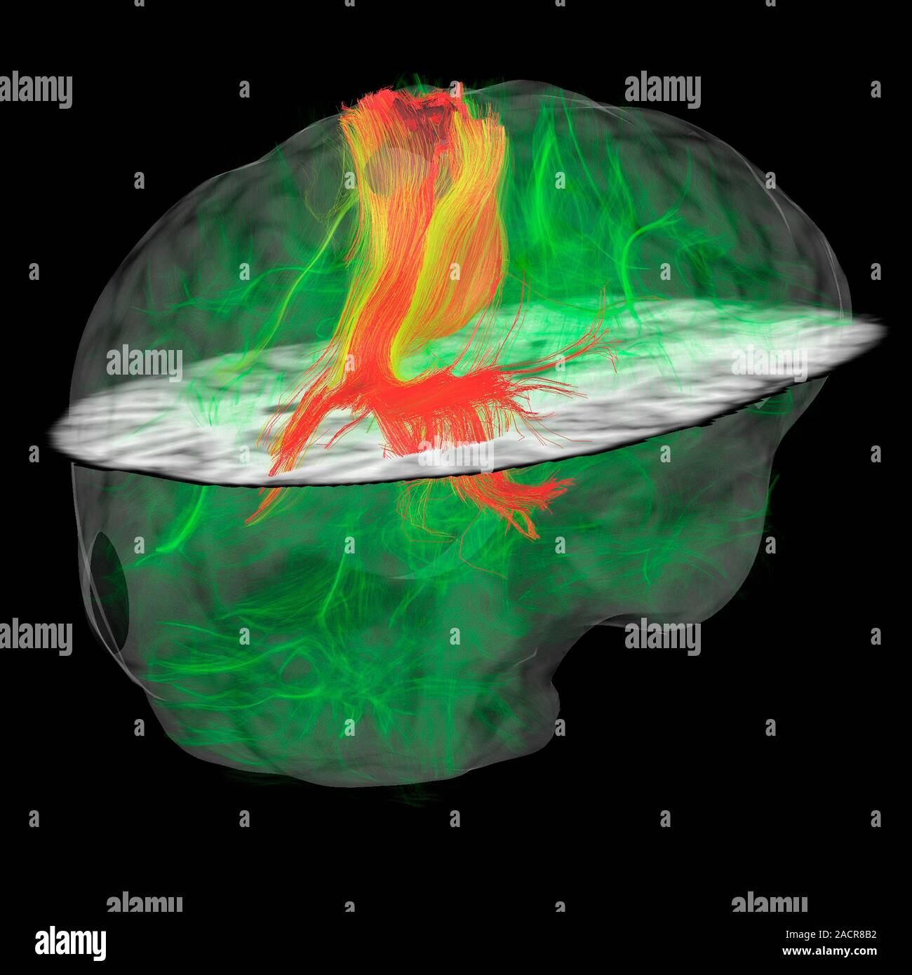 Glioblastoma brain tumour. 3D diffusion tensor imaging (DTI) magnetic resonance imaging (MRI ...
