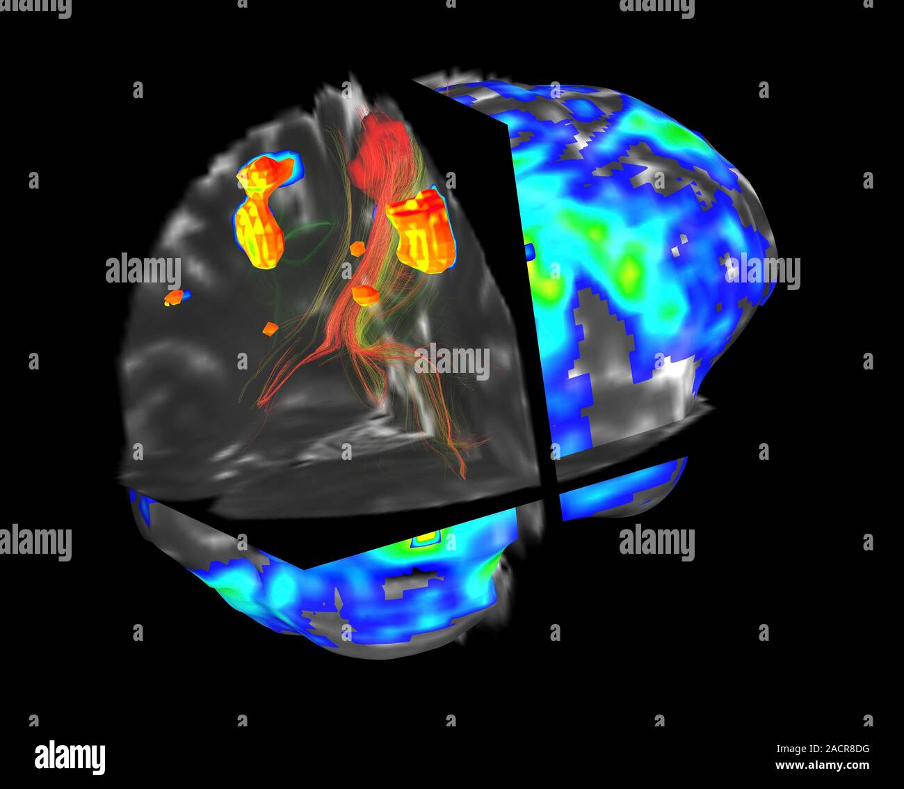 Brain tumour, fMRI and tractography. Combined functional magnetic ... Brain tumour, fMRI and tractography. Combined functional magnetic ...