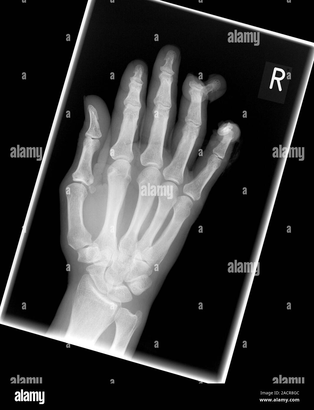 Amputated fingers. X-ray of the right hand of a 57 year old male ...