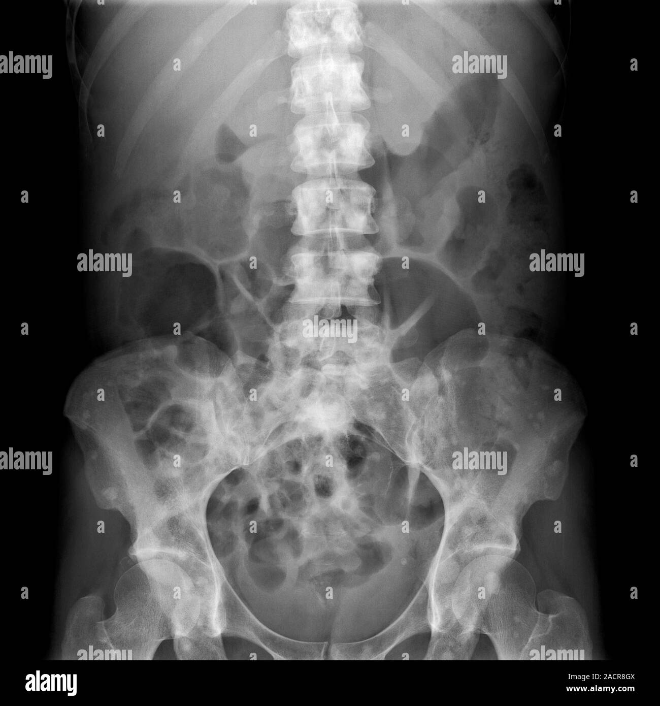 Secondary bone cancer. X-ray of the abdomen of a 40 year old female ...
