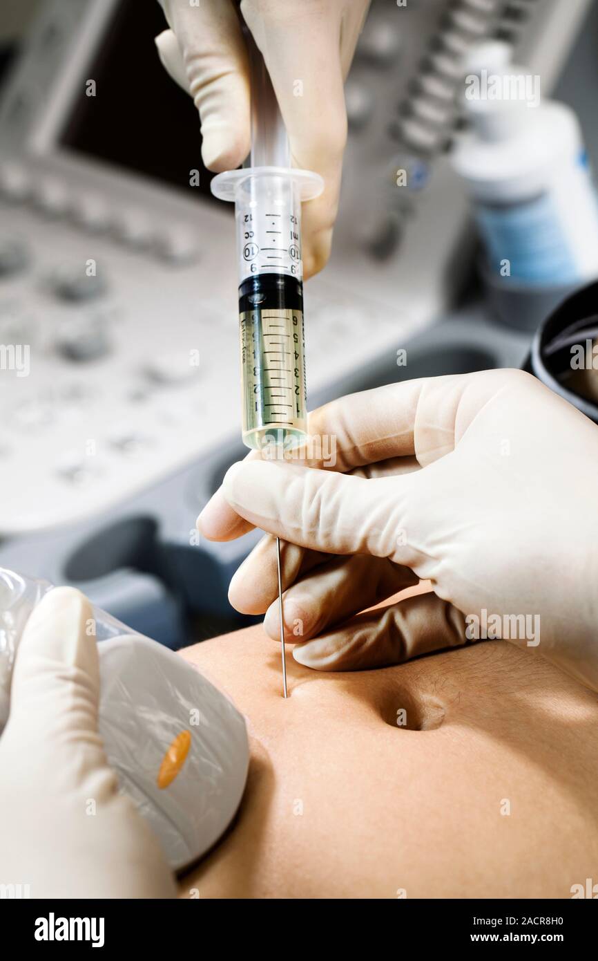 Amniocentesis test in pregnancy. This test is performed on pregnant ...