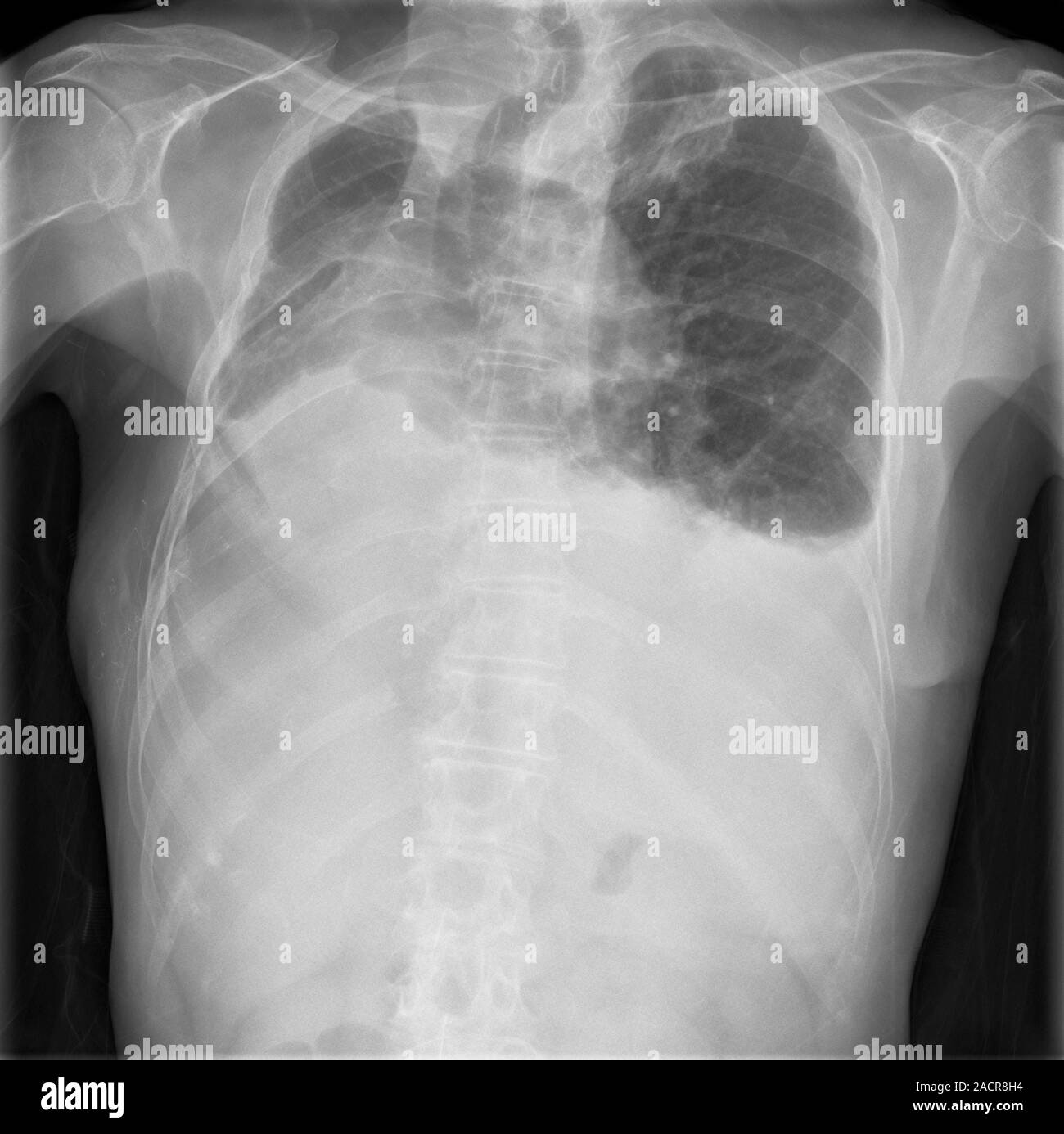 Lung disease. X-ray of the chest of a 70 year old female patient who ...