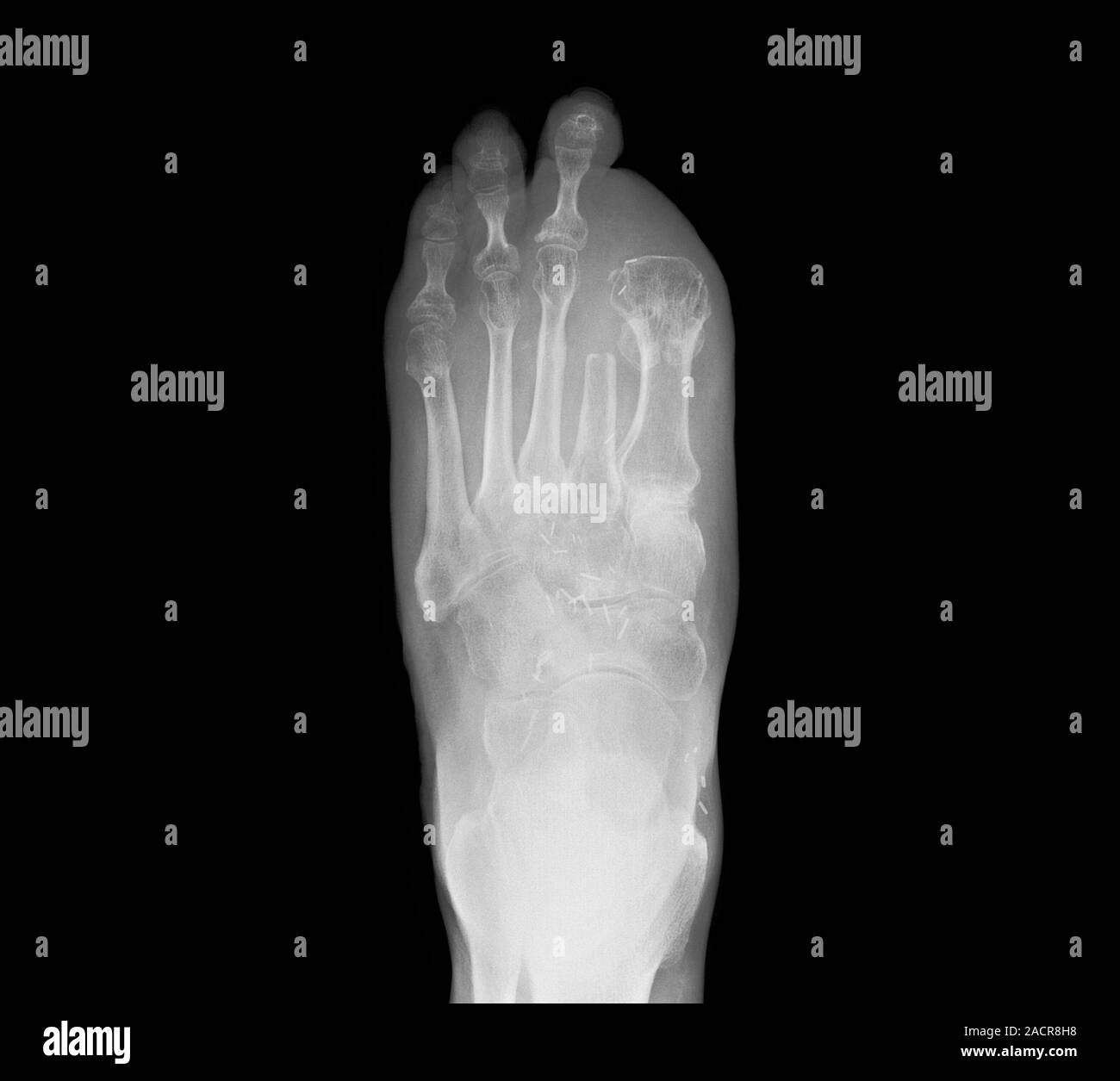 Amputated toe. X-ray of the left foot of a 75 year old male patient ...