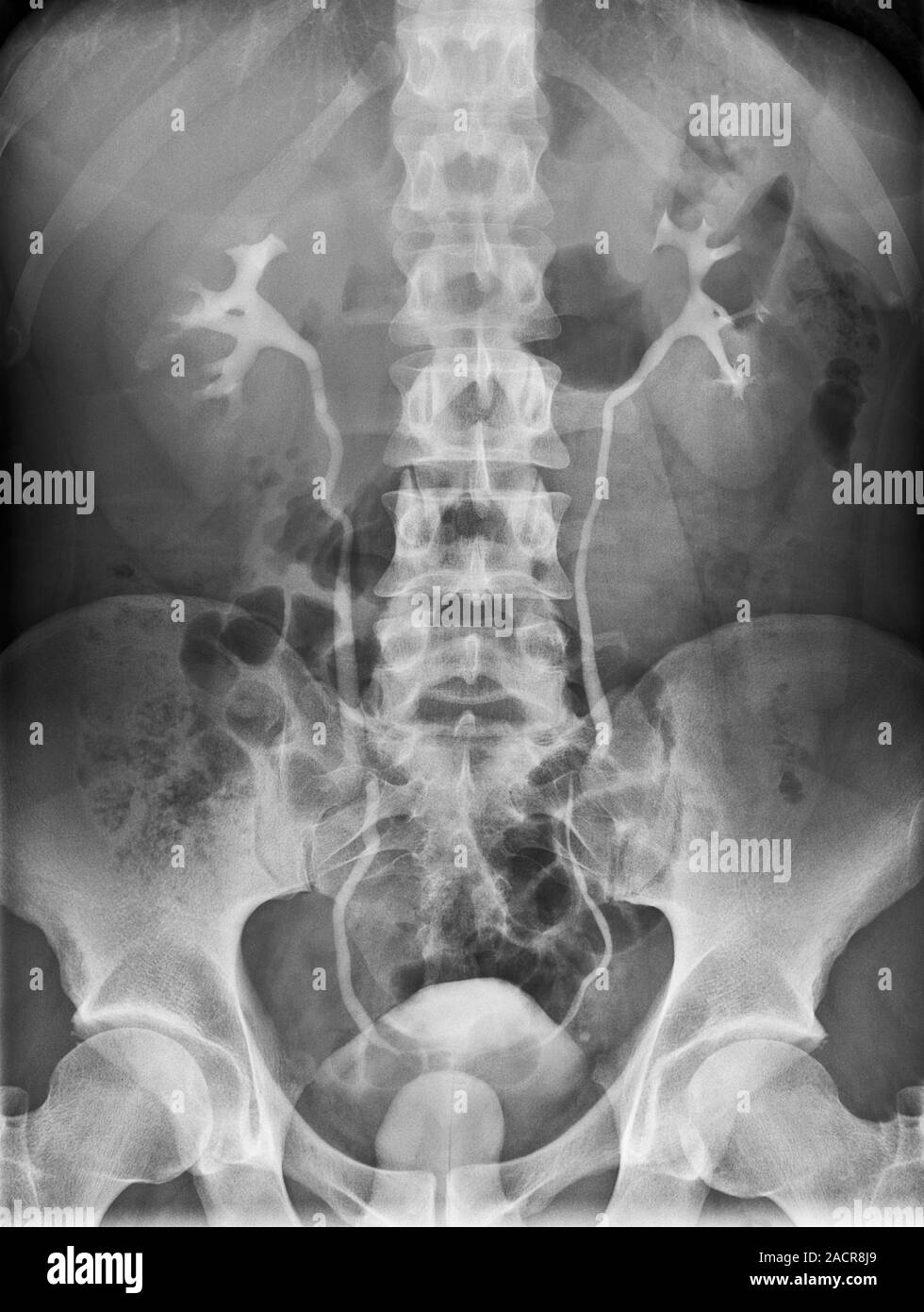 Healthy urinary tract. Intravenous urogram (X-ray) showing the healthy ...