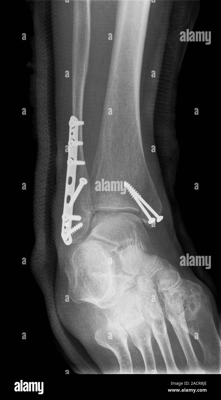 Pinned broken ankle. X-ray of the lower leg of an 85 year old female ...