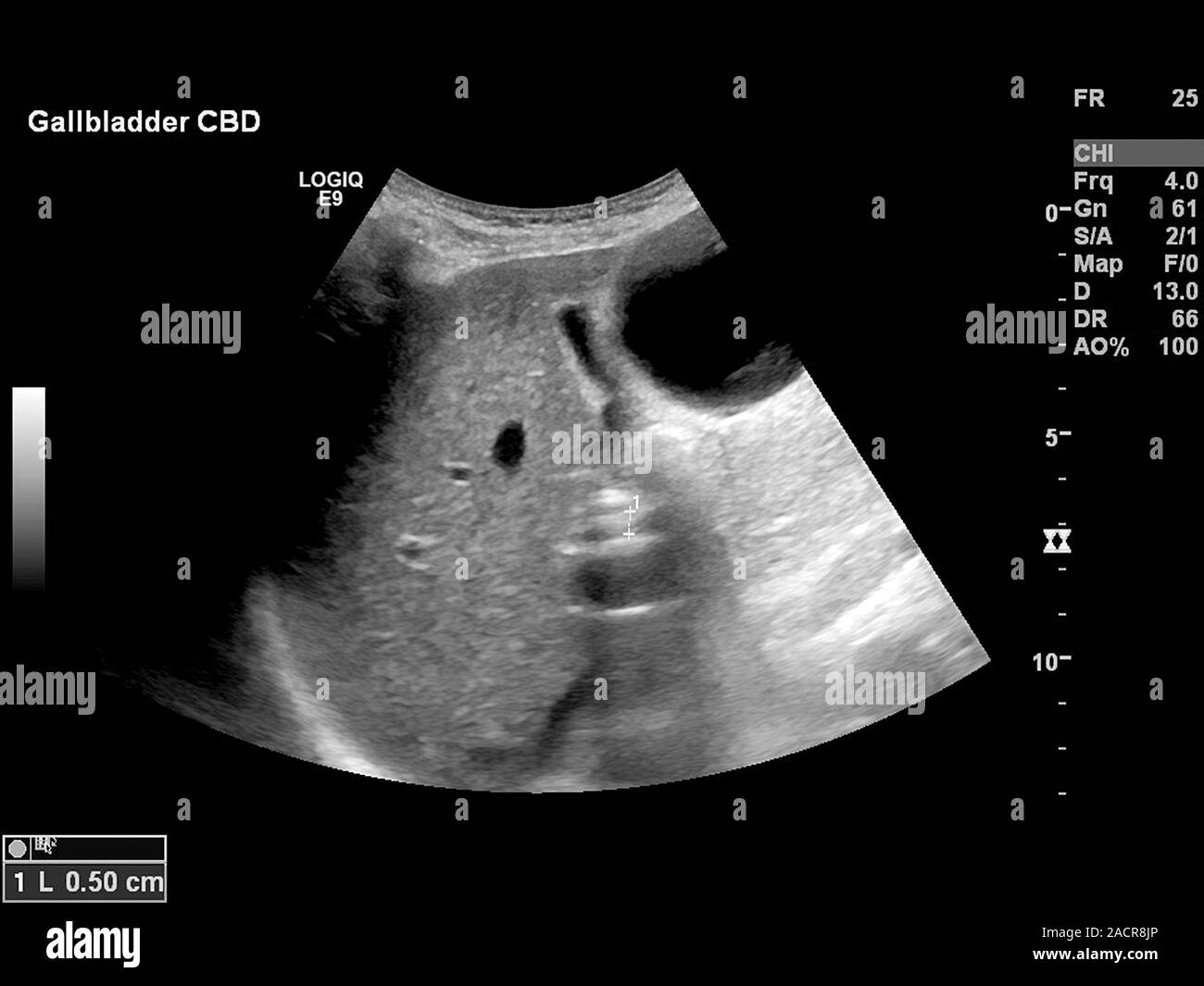 Gallbladder disease. Ultrasound scan of the gallbladder of an 84 year ...
