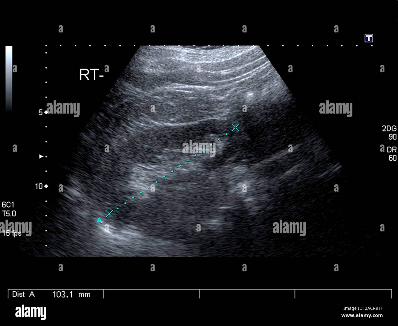 Bladder stones. Ultrasound scan of the bladder of a 58 year old male ...