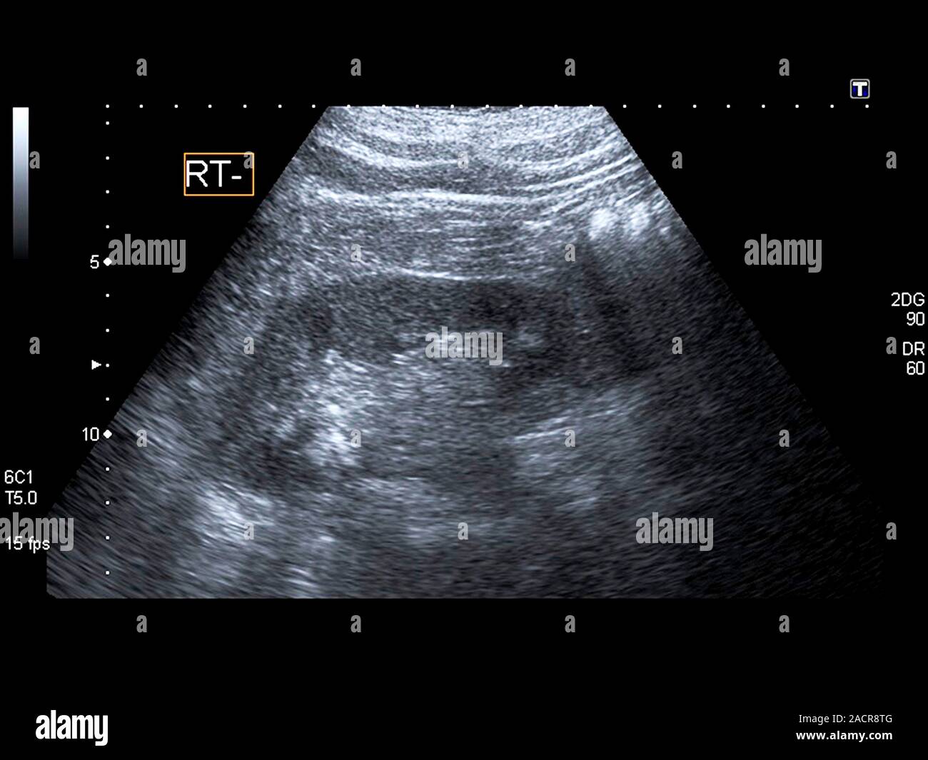 Bladder stones. Ultrasound scan of the bladder of a 58 year old male ...