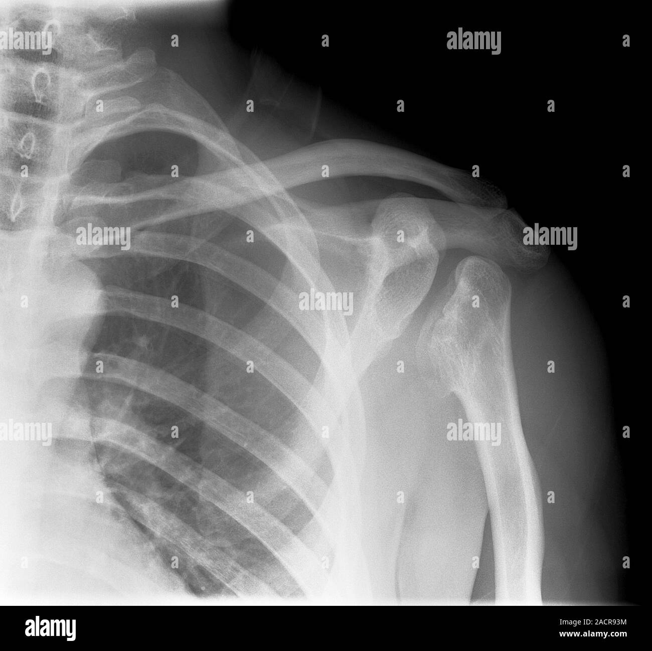 Septic arthritis. X-ray of the shoulder joint of a 24 year old male ...