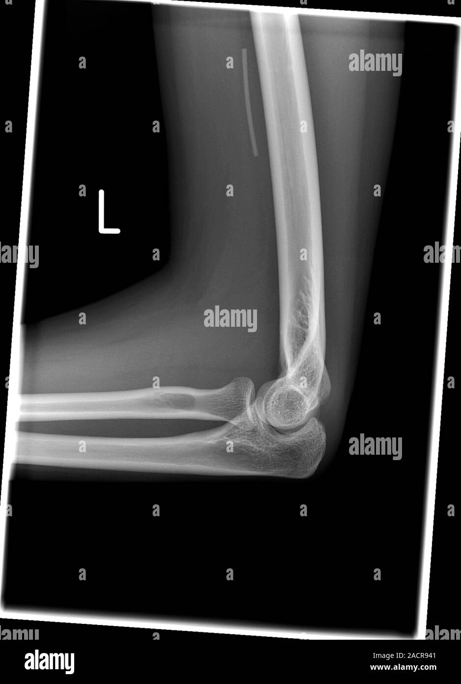 Contraceptive implant. X-ray of the arm of a 19 year old female showing ...