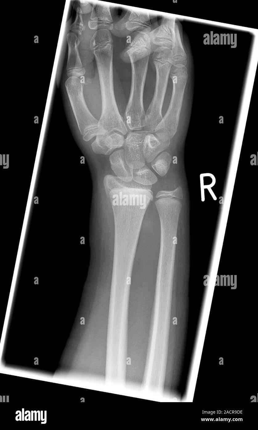 Salter Hariss fracture. X-ray of the wrist of a 10 year old female ...
