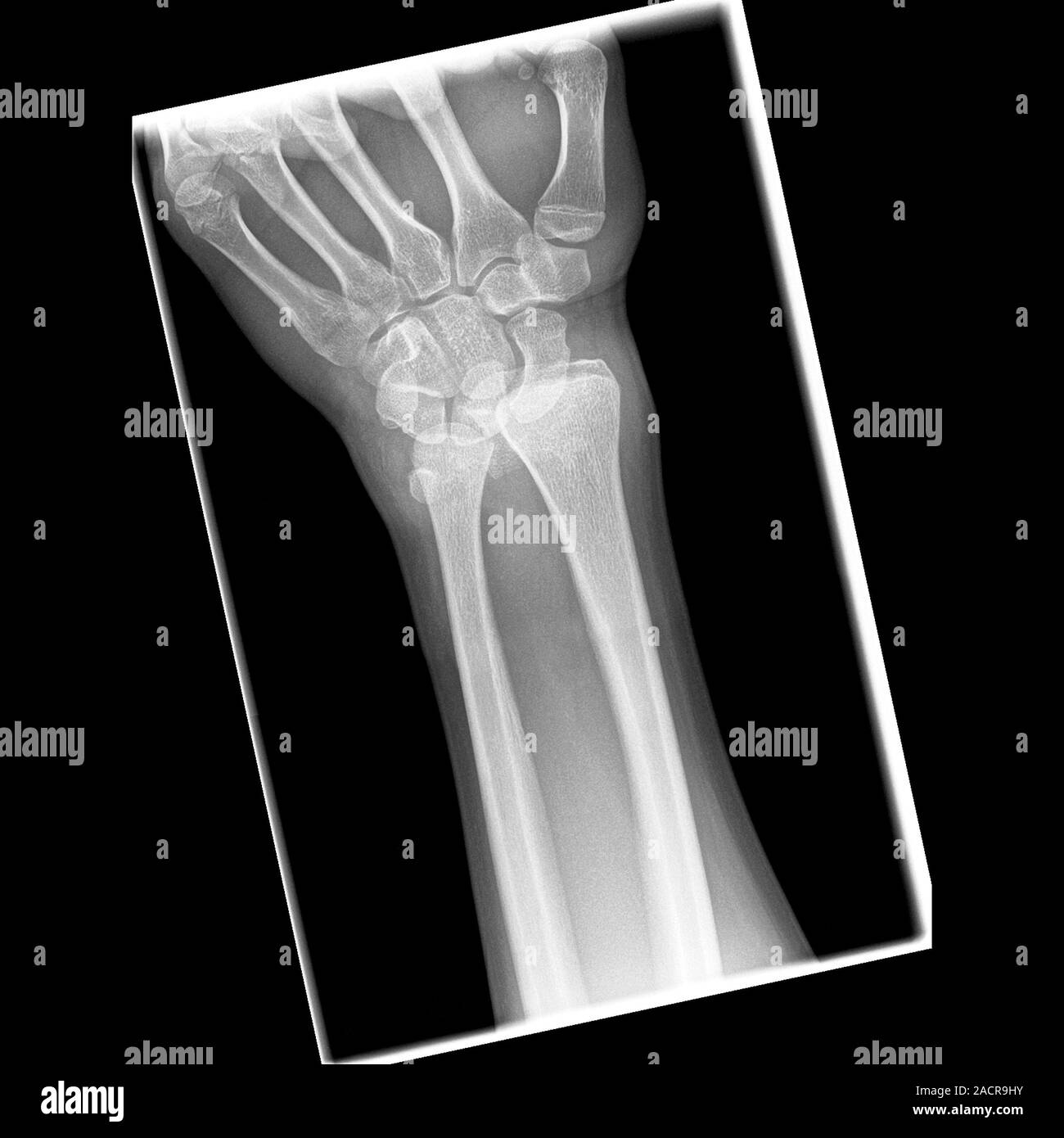Dislocated wrist. X-ray of the wrist of a 16 year old male that has ...