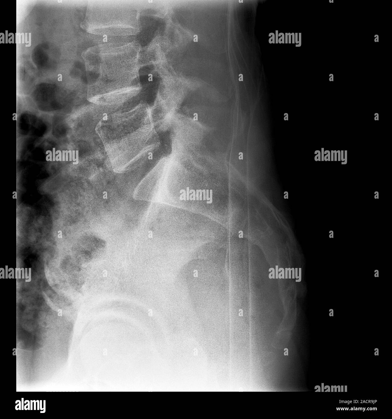 Fractured vertebra. X-ray of the lower spine of a 50 year old male with ...